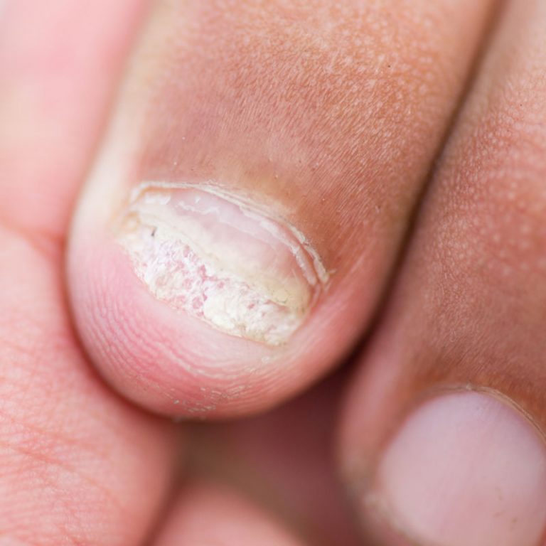 Doenças das unhas – Instituto Dermatológico